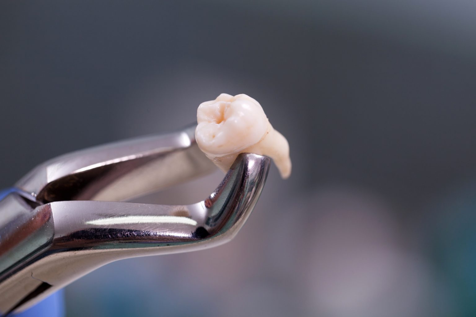Wisdom Teeth Extraction: What to Expect from Your Upcoming Procedure ...